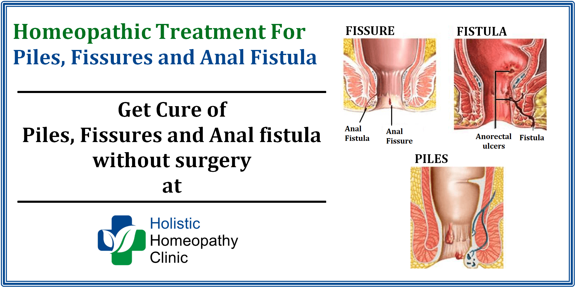 Piles and Fissures - Holistic Homeopathy